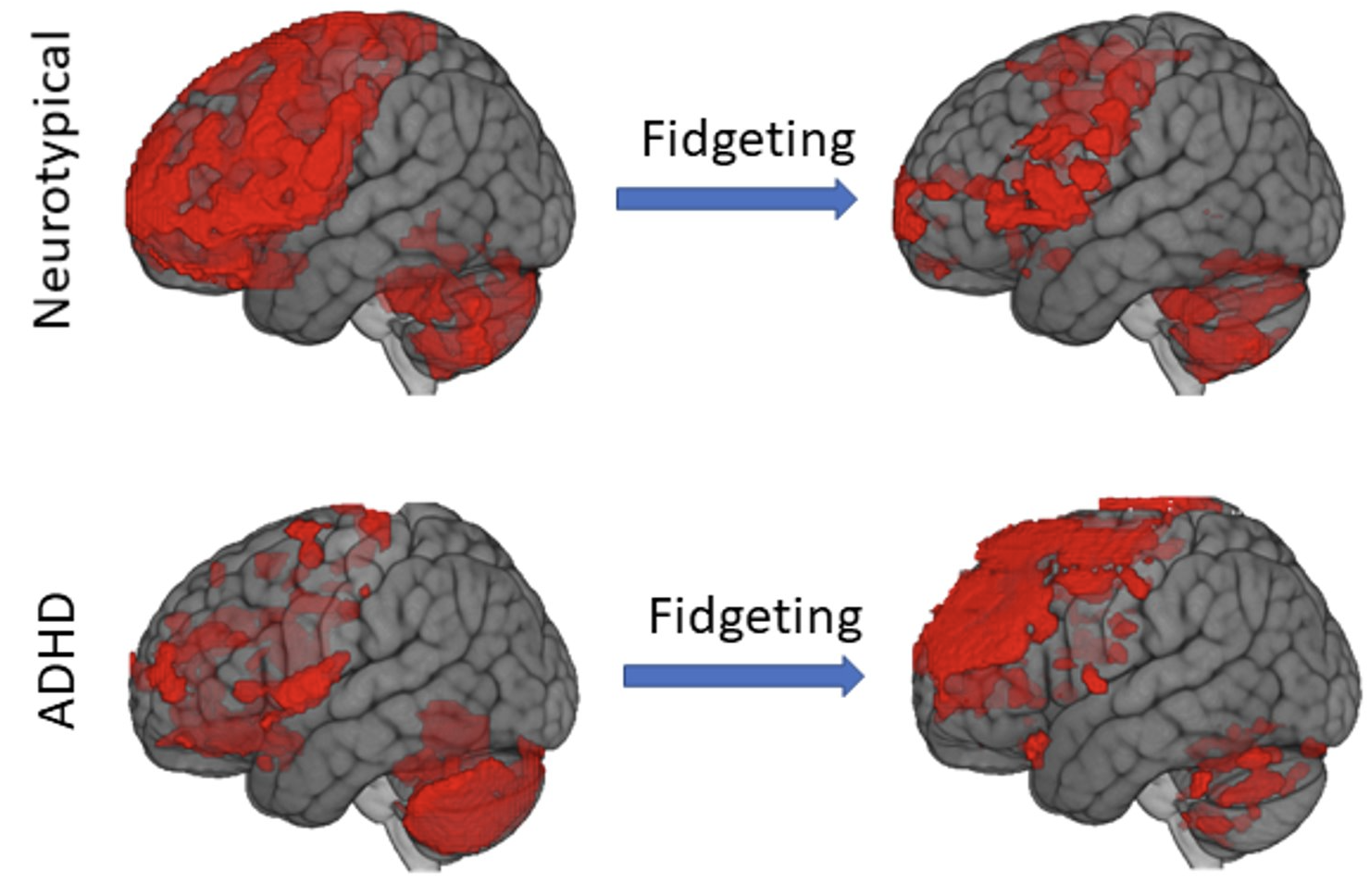 ADHD – Mātai Medical Research Institute